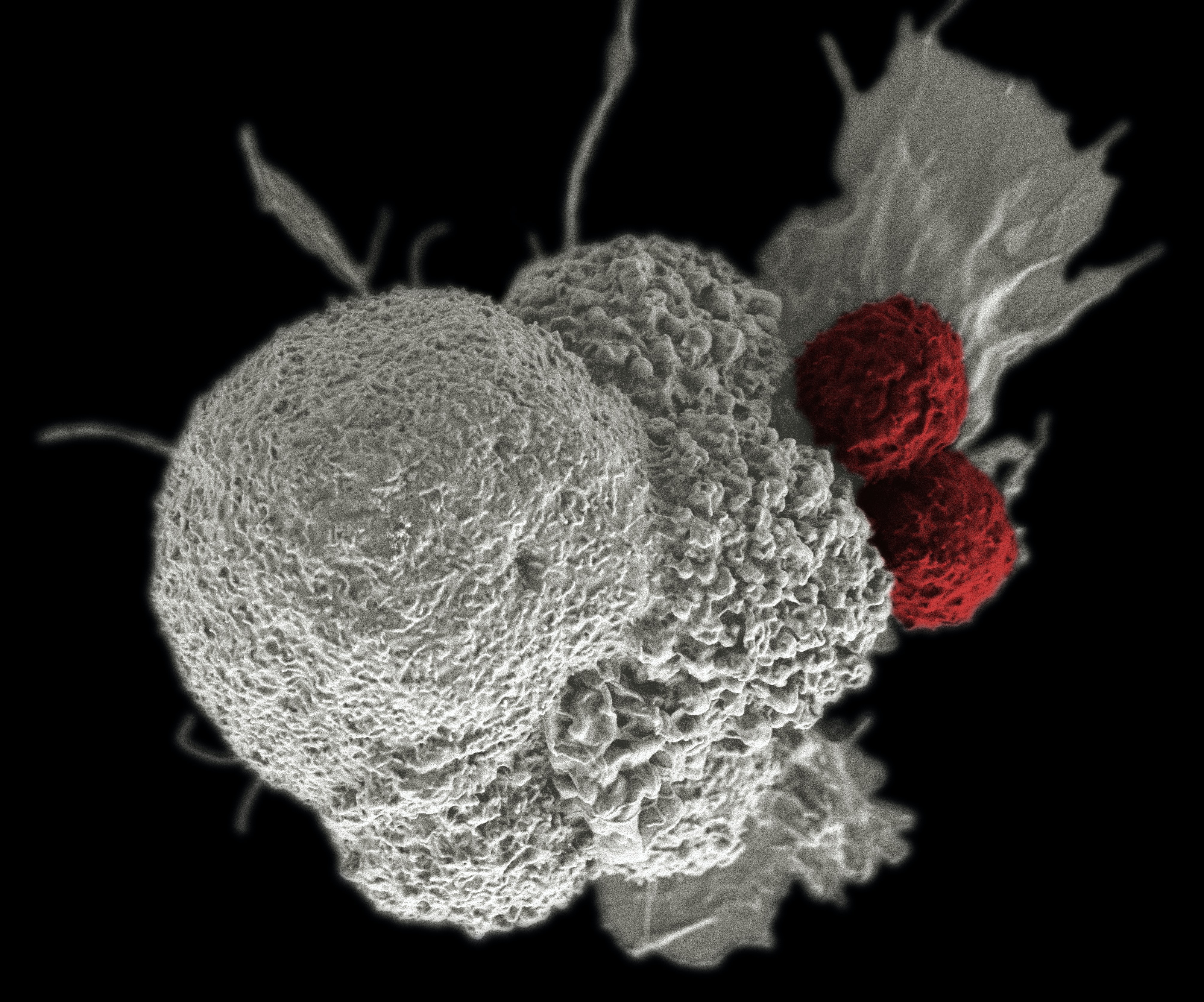 Biopsy | Head and Neck Cancer Australia