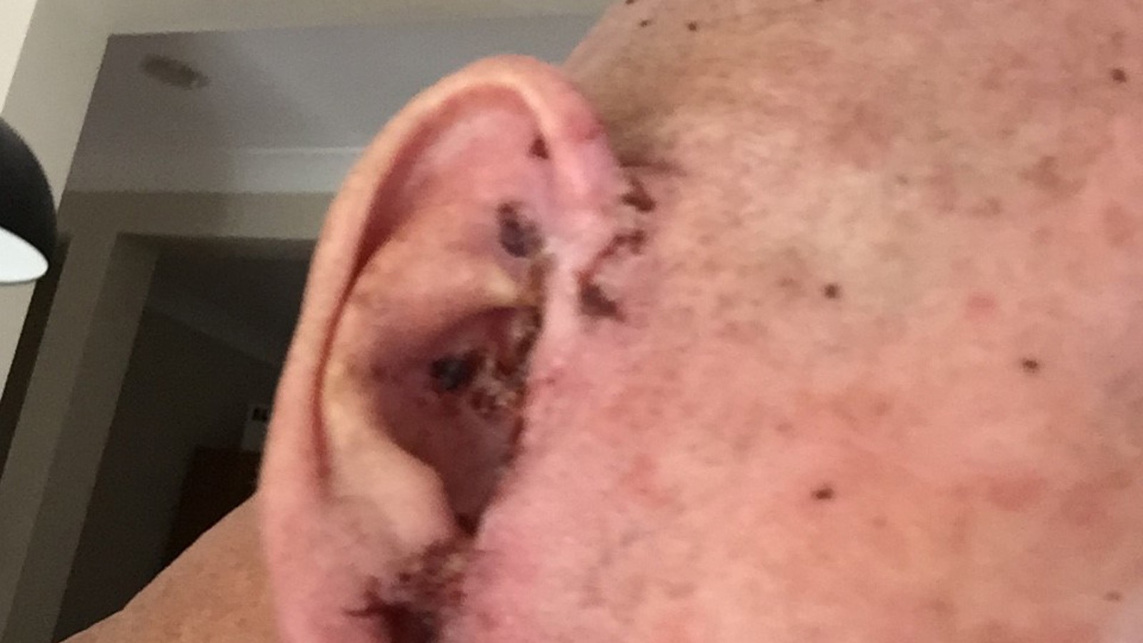 A BCC leads to major surgery and a prosthetic ear - Head and Neck ...